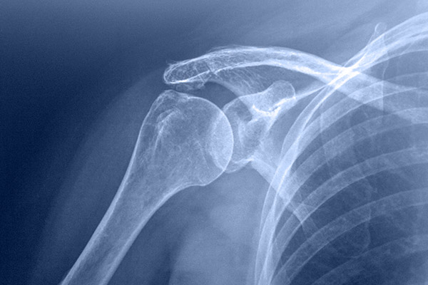 Σύνδρομο Πρόσκρουσης Ώμου | totalorthocare.gr - Τotal Οrtho Care
